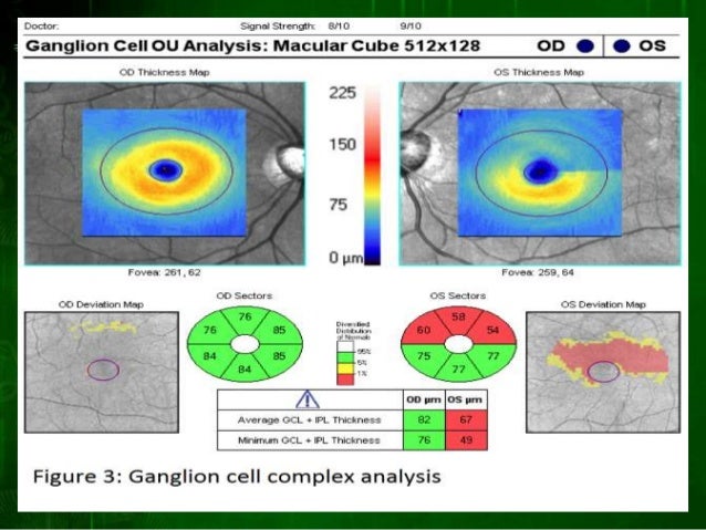 Role of oct in glaucoma