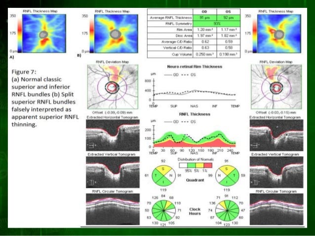 Role of oct in glaucoma