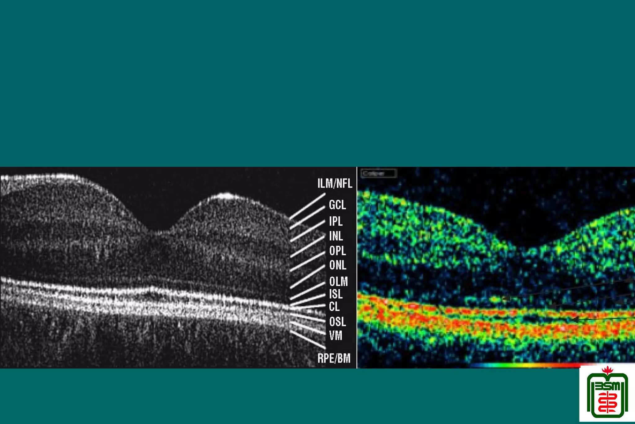 Optical Coherence Tomography (OCT) | PPT