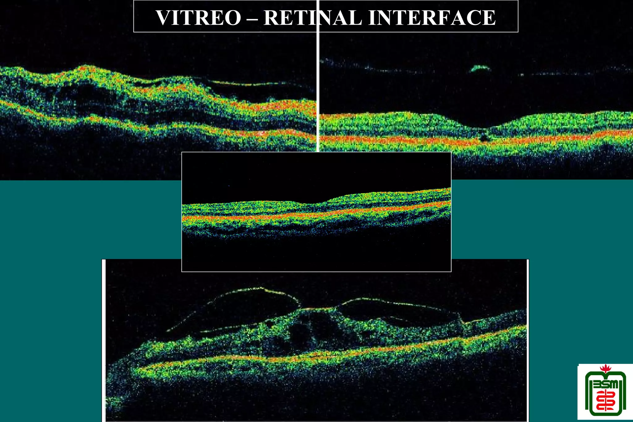 Optical Coherence Tomography (OCT) | PPT