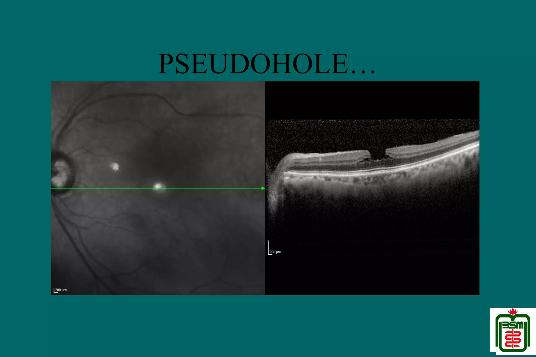Optical Coherence Tomography (OCT) | PPT