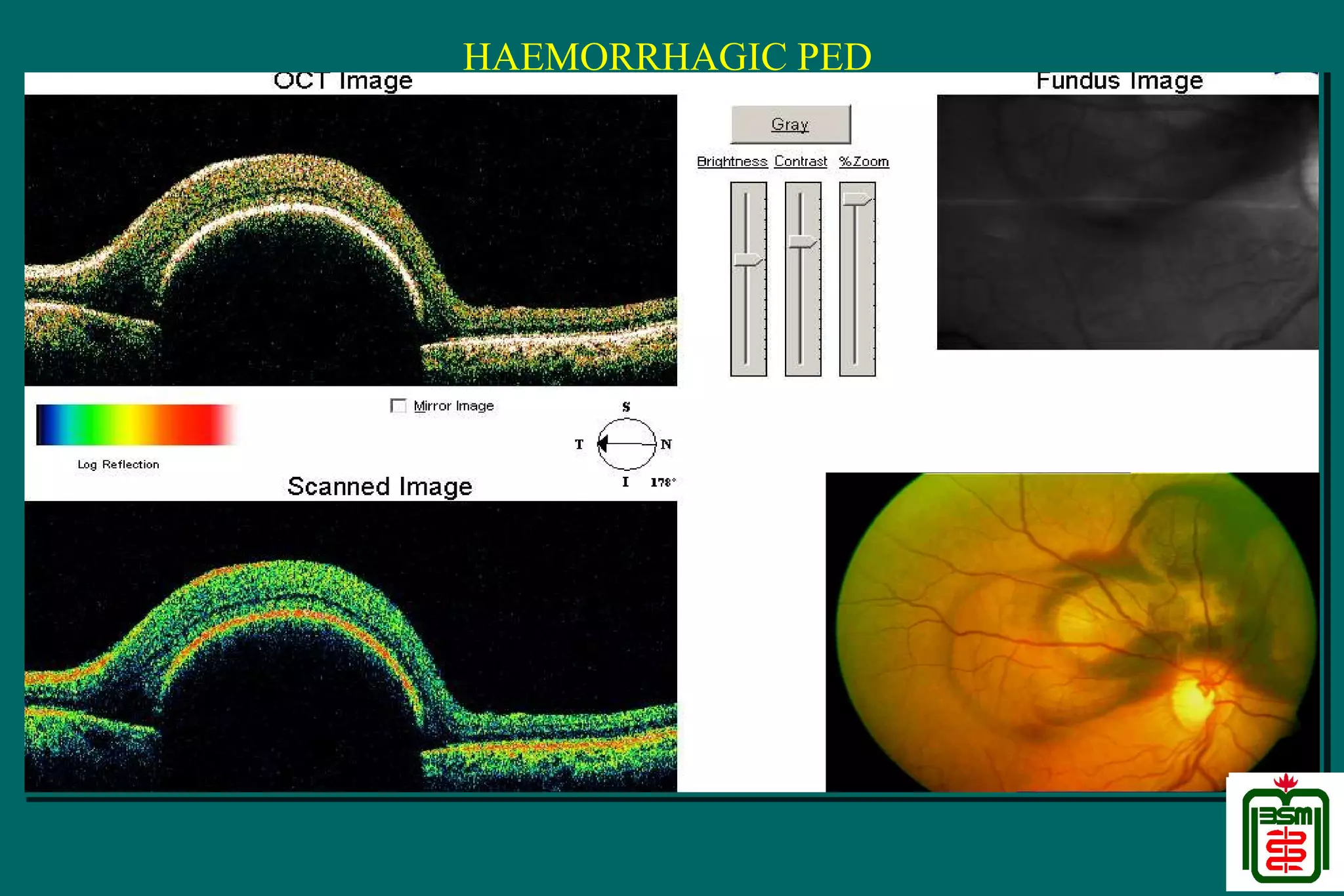 Optical Coherence Tomography (OCT) | PPT