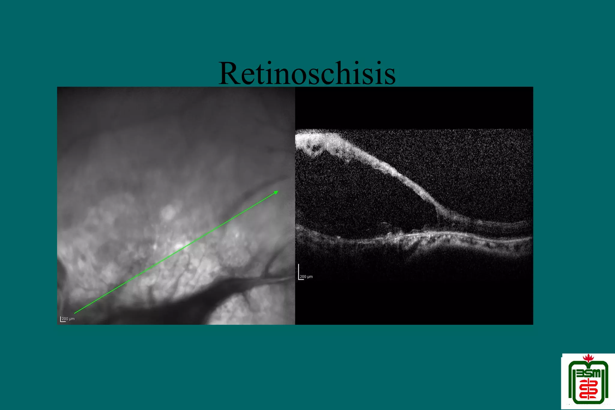 Optical Coherence Tomography (OCT) | PPT