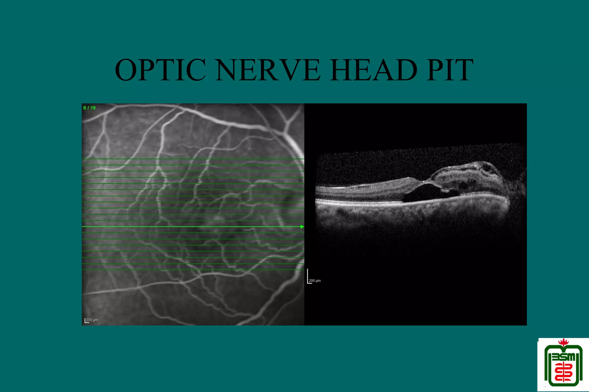 Optical Coherence Tomography (OCT) | PPT