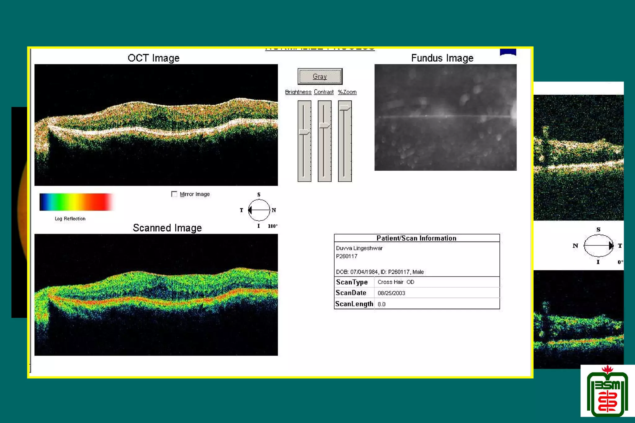 Optical Coherence Tomography (OCT) | PPT