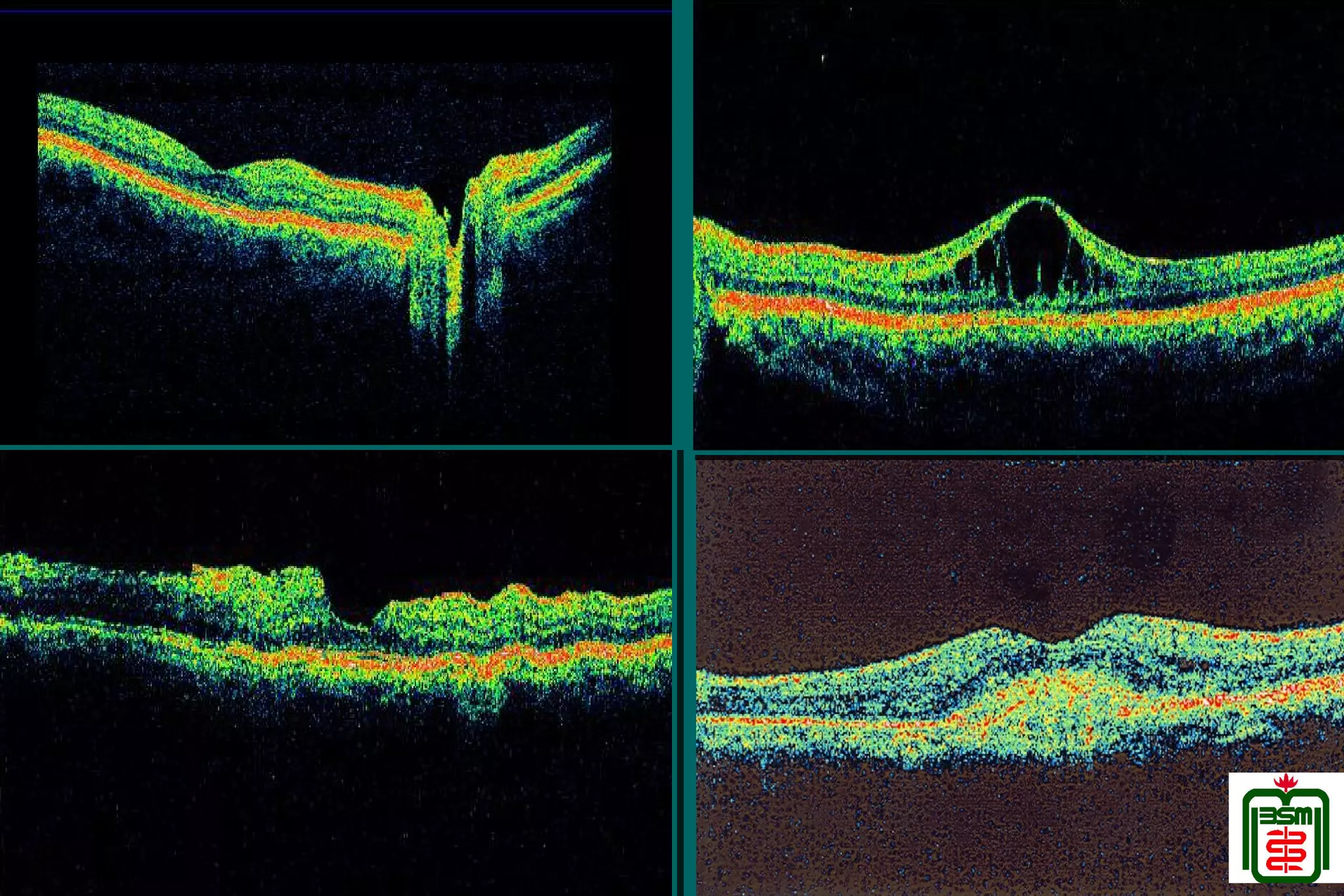 Optical Coherence Tomography (OCT) | PPT