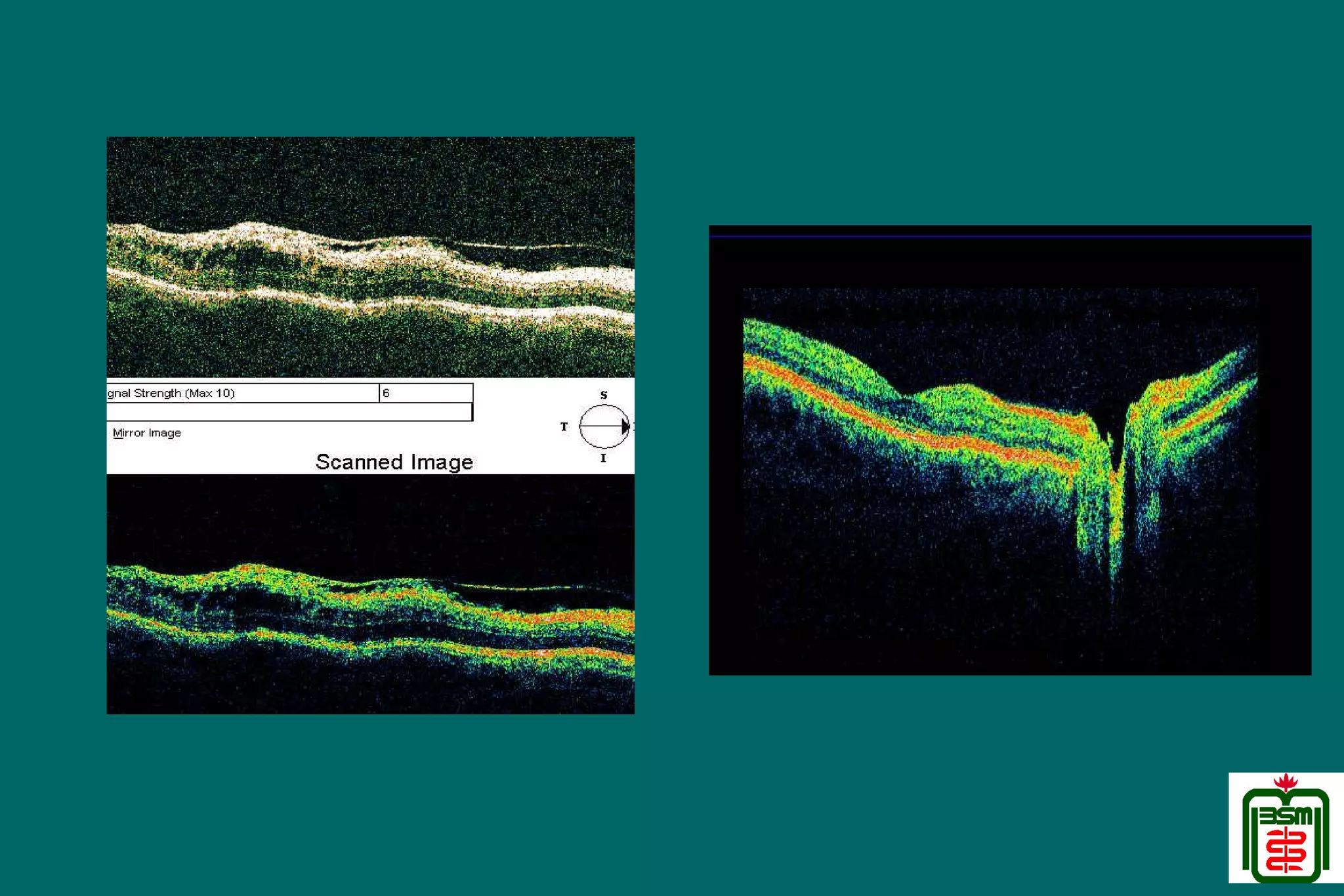 Optical Coherence Tomography (OCT) | PPT