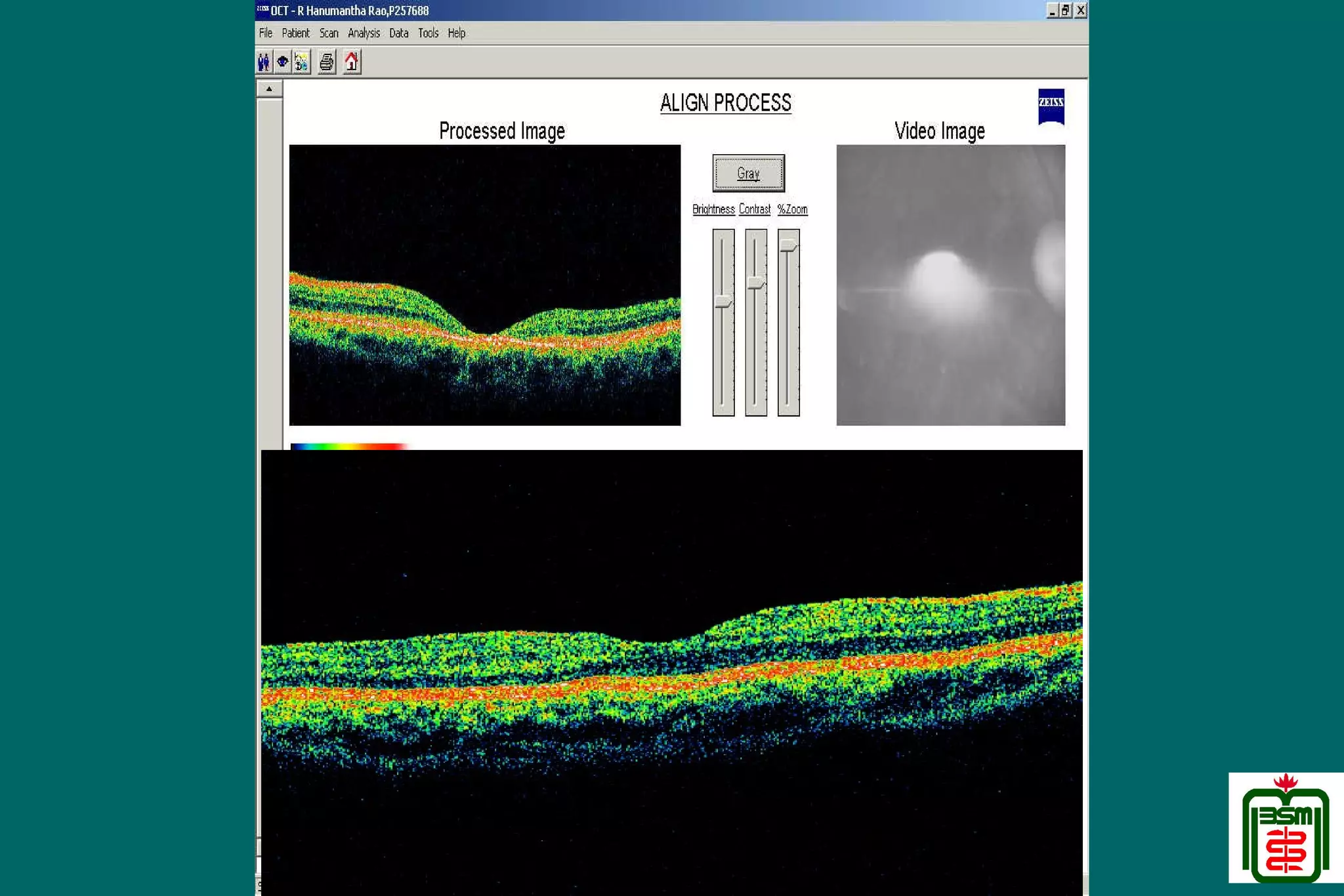 Optical Coherence Tomography (OCT) | PPT