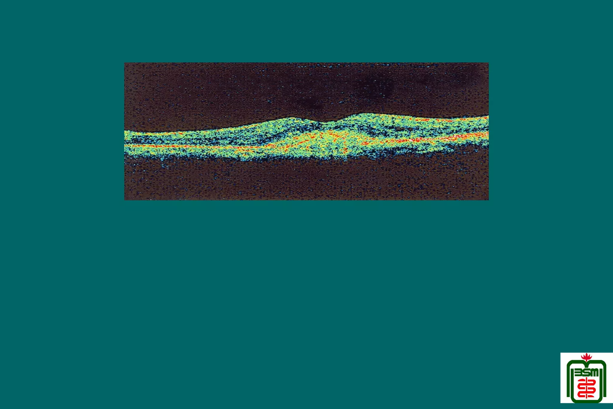 Optical Coherence Tomography (OCT) | PPT
