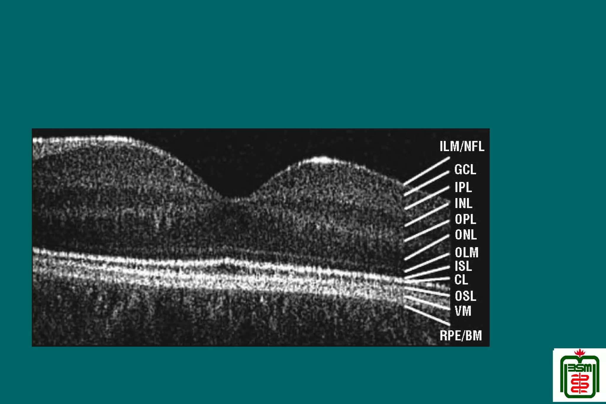 Optical Coherence Tomography (OCT) | PPT