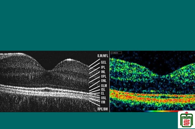 Optical Coherence Tomography (OCT) | PPT