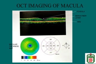 Optical Coherence Tomography (OCT) | PPT