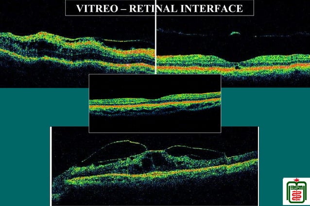 Optical Coherence Tomography (OCT) | PPT