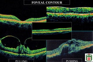 Optical Coherence Tomography (OCT) | PPT