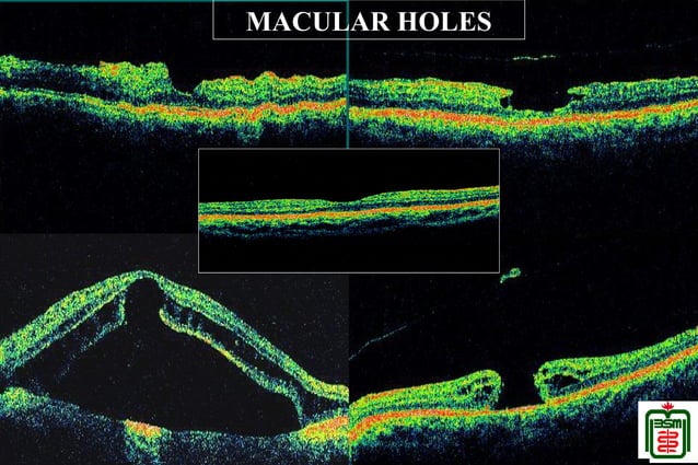 Optical Coherence Tomography (OCT) | PPT