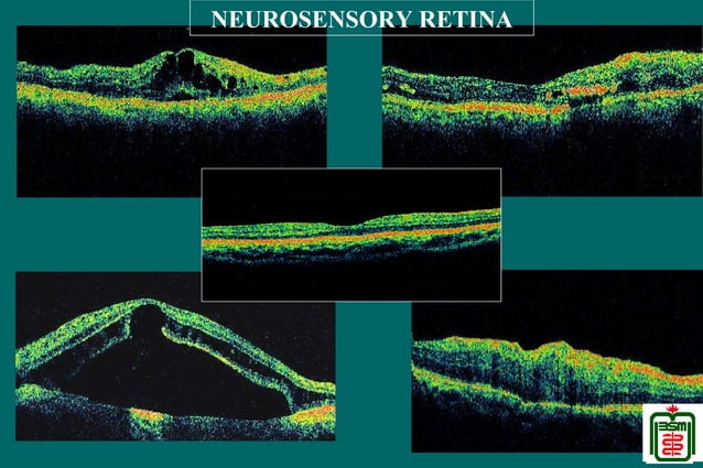Optical Coherence Tomography (OCT) | PPT