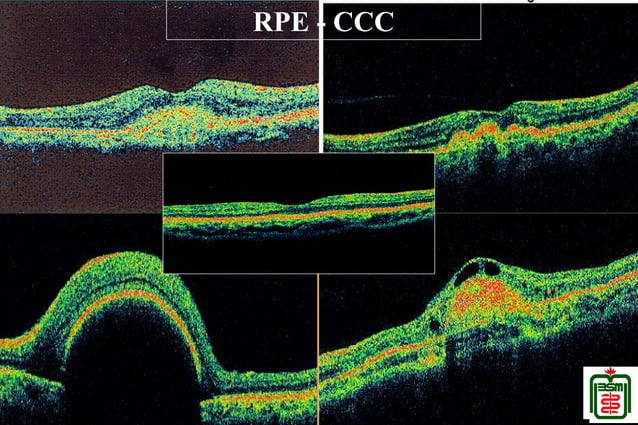 Optical Coherence Tomography (OCT) | PPT
