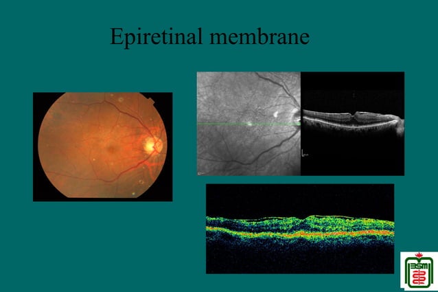 Optical Coherence Tomography (OCT) | PPT