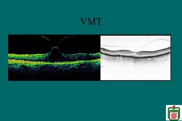 Optical Coherence Tomography (OCT) | PPT