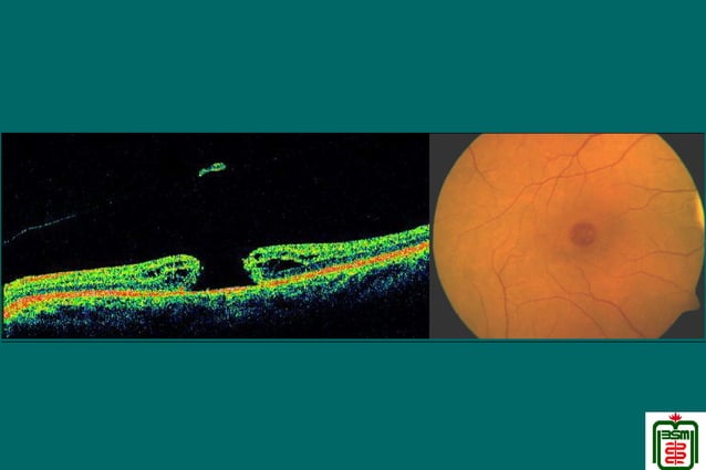 Optical Coherence Tomography (OCT) | PPT