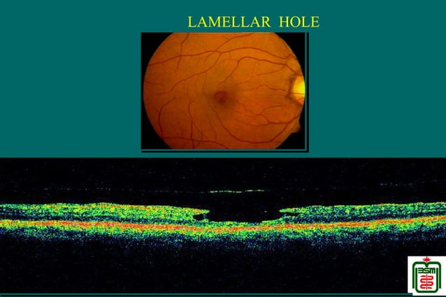 Optical Coherence Tomography (OCT) | PPT