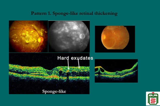 Optical Coherence Tomography (OCT) | PPT