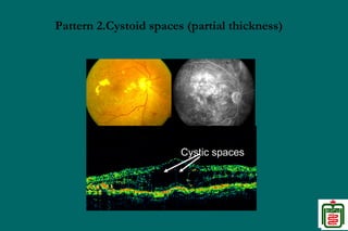 Optical Coherence Tomography (OCT) | PPT