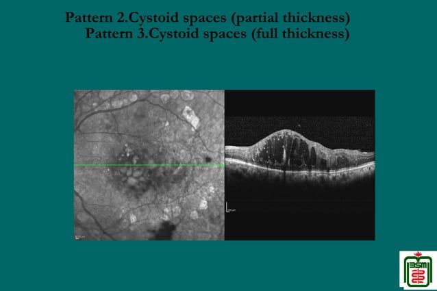 Optical Coherence Tomography (OCT) | PPT