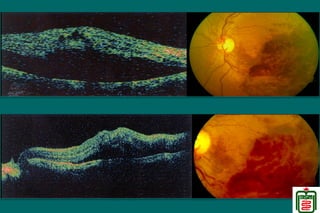 Optical Coherence Tomography (OCT) | PPT