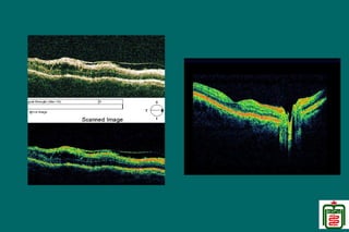 Optical Coherence Tomography (OCT) | PPT