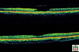 Optical Coherence Tomography (OCT) | PPT