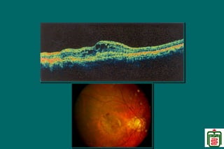 Optical Coherence Tomography (OCT) | PPT