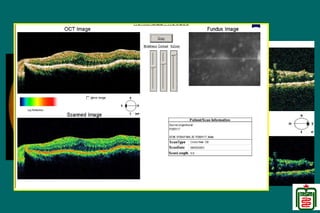 Optical coherence tomography oct - miloys