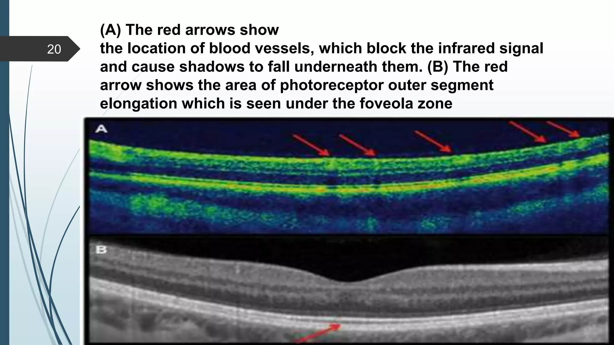 Role of oct in ophthalmology | PPTX
