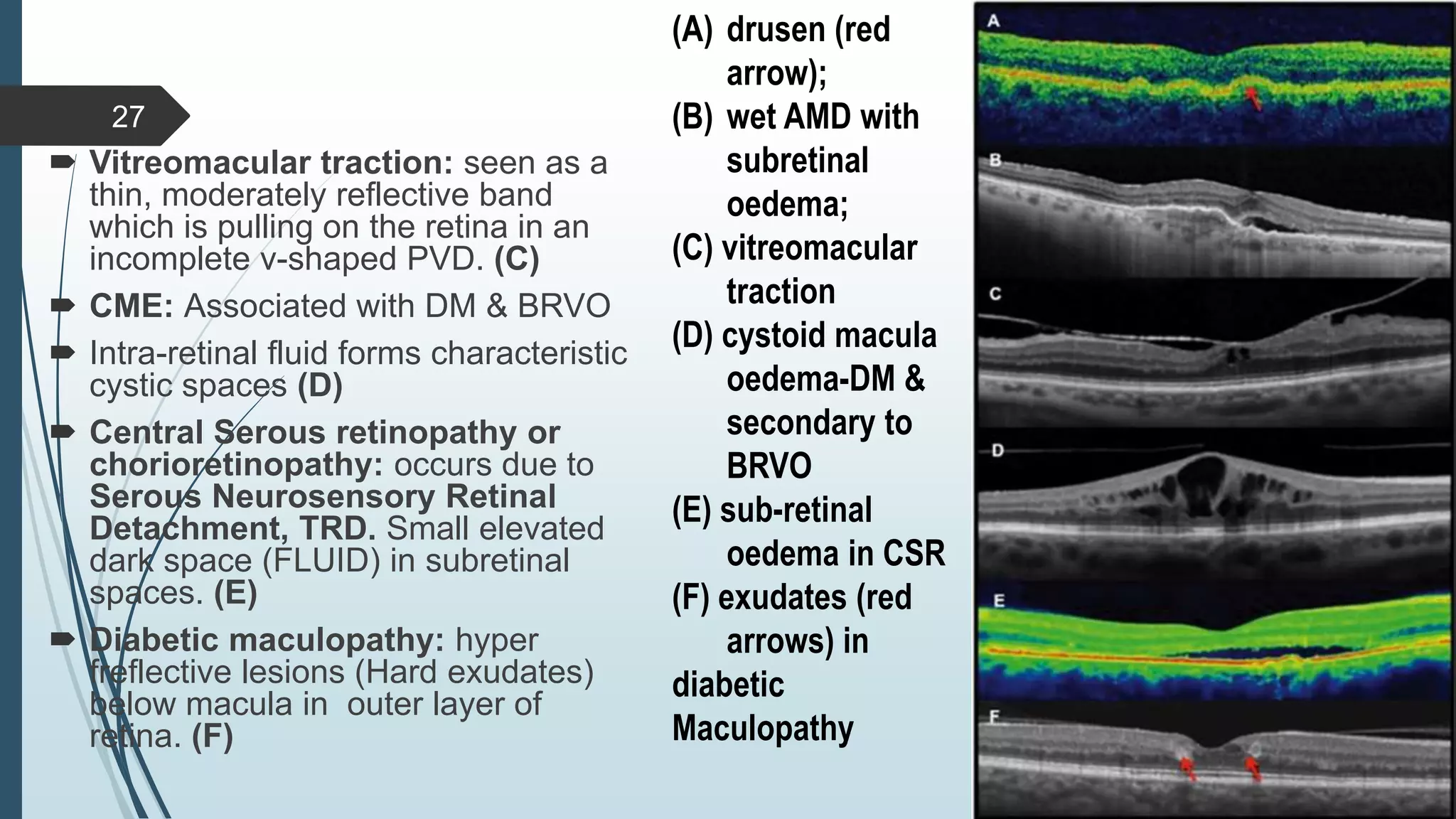 Role of oct in ophthalmology | PPTX