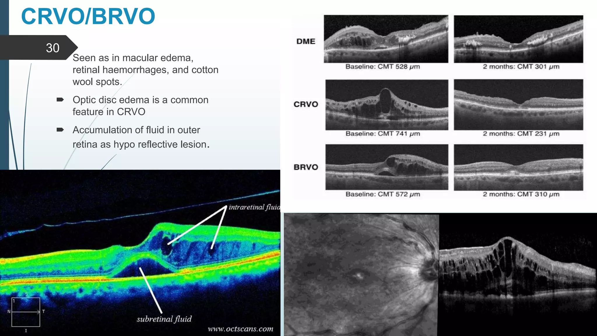 Role of oct in ophthalmology | PPTX