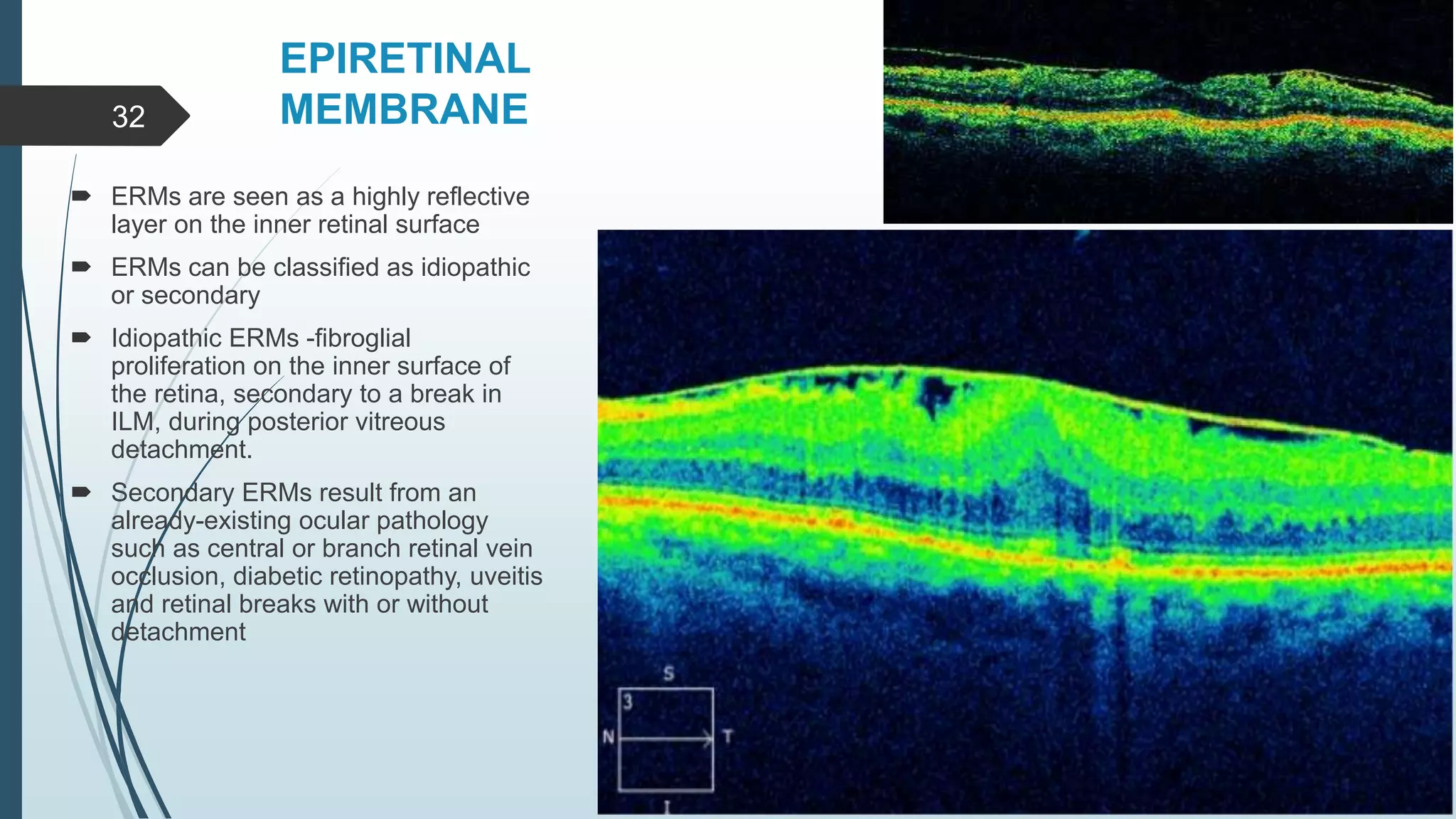 Role of oct in ophthalmology | PPTX