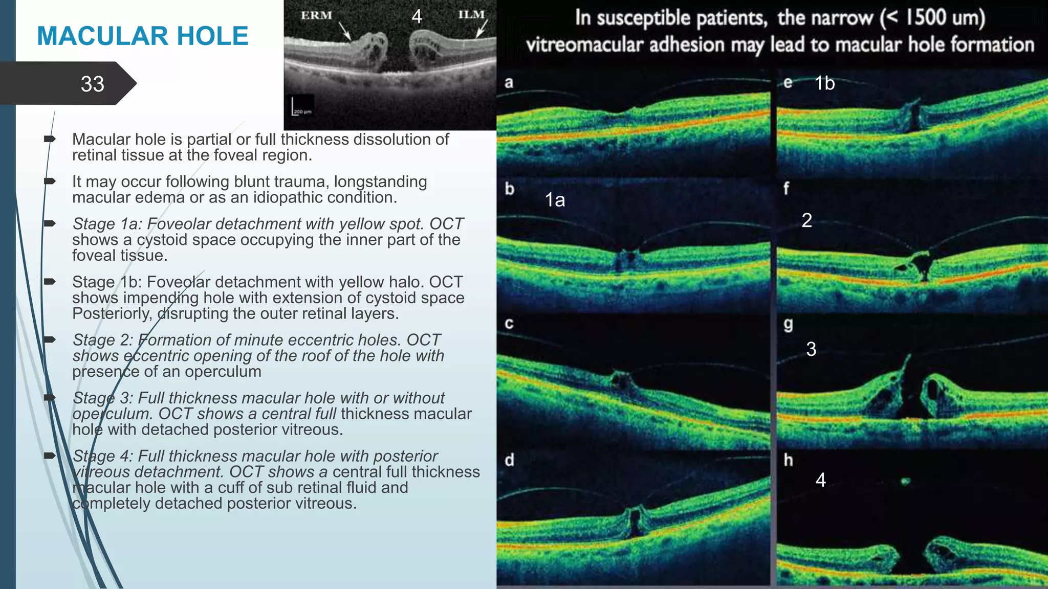 Role of oct in ophthalmology | PPTX