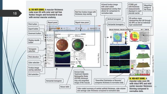 Role of oct in ophthalmology | PPTX