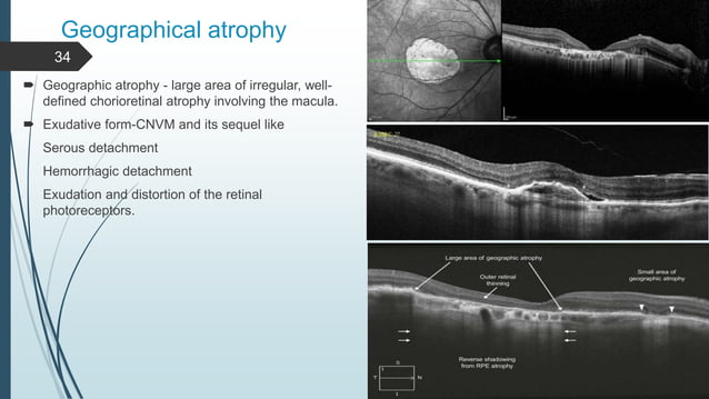 Role of oct in ophthalmology | PPTX