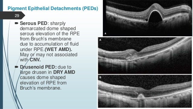 Role of oct in ophthalmology