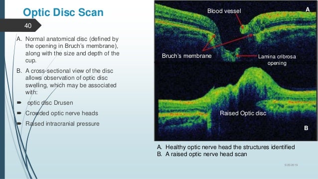 Role of oct in ophthalmology