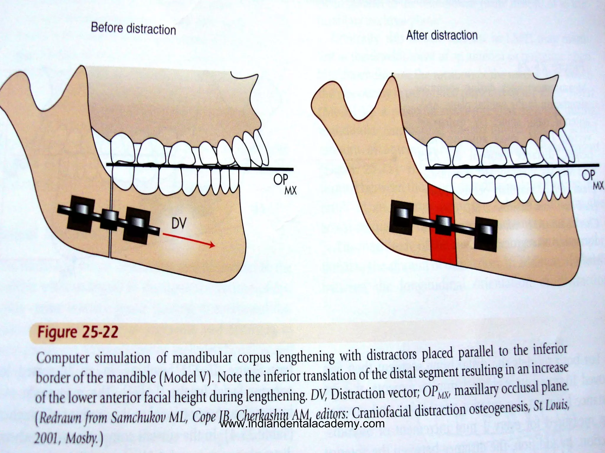 Role of orthodontist in mandibular distraction / dental implant courses ...