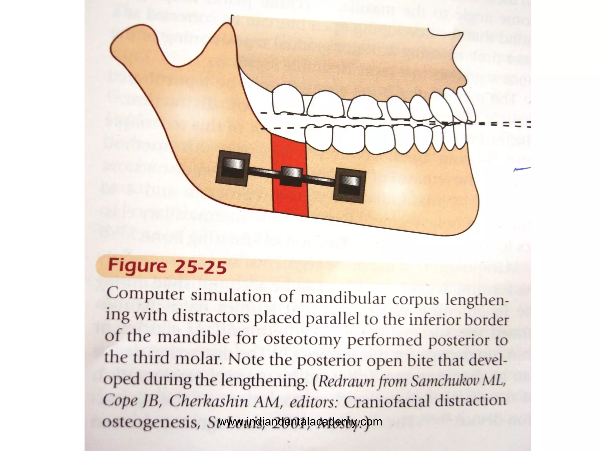 Role of orthodontist in mandibular distraction / dental implant courses ...