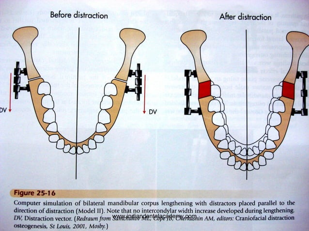 Role of orthodontist in mandibular distraction / dental implant courses ...