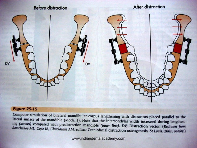 Role of orthodontist in mandibular distraction / dental implant courses ...