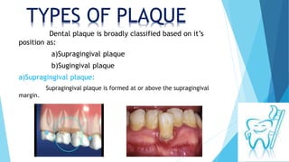 Role of plaque in etiology of dental caries | PPTX
