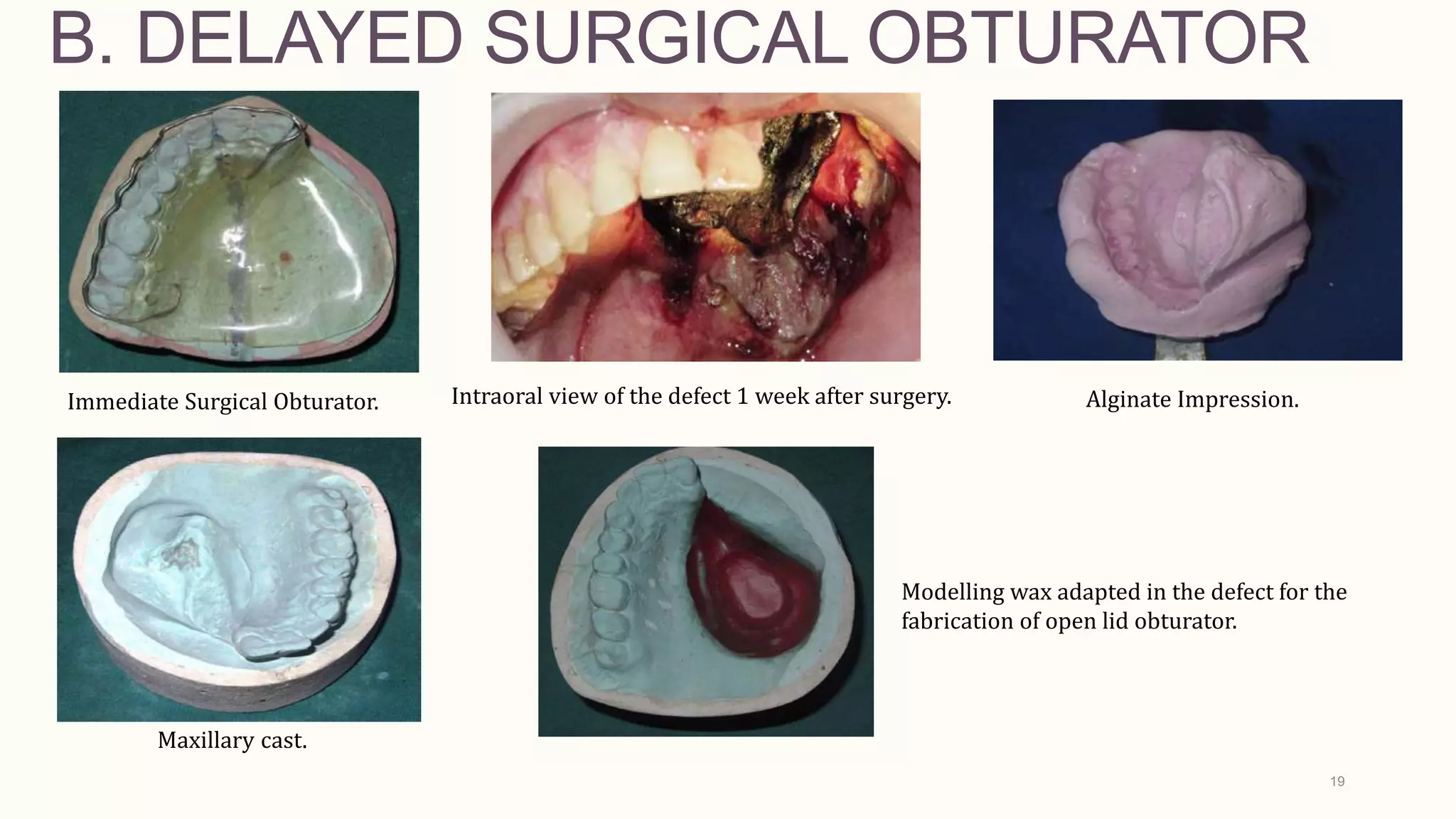 ROLE OF PROSTHODONTIC REHABILITATION AFTER SURGERY OF ORAL.pptx