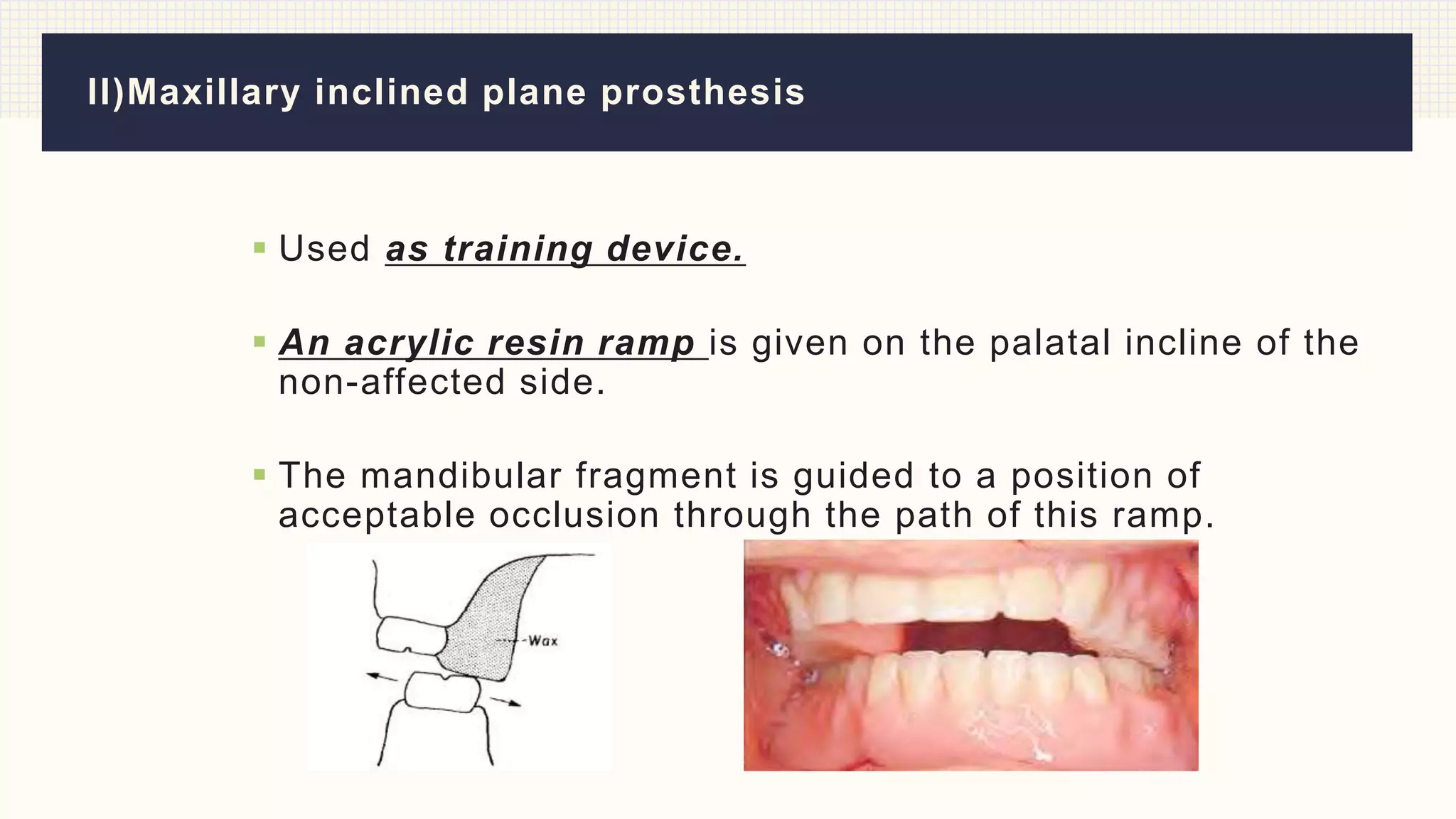 ROLE OF PROSTHODONTIC REHABILITATION AFTER SURGERY OF ORAL.pptx