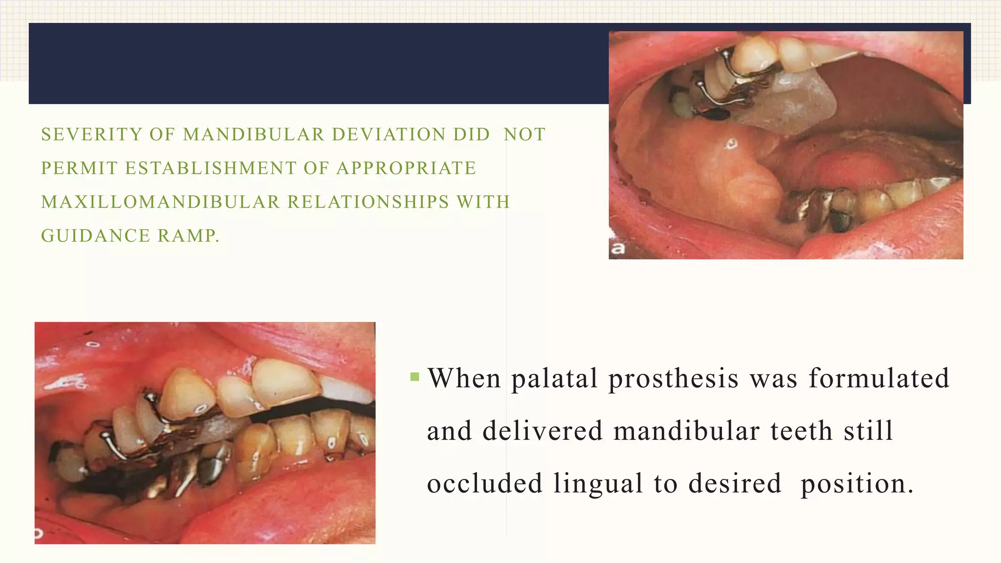 ROLE OF PROSTHODONTIC REHABILITATION AFTER SURGERY OF ORAL.pptx